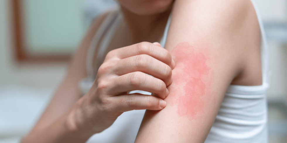 How to Tell If You Are Allergic to Cannabis